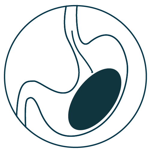 Allurion Intra-Gastric Balloon – Q Obesity Center